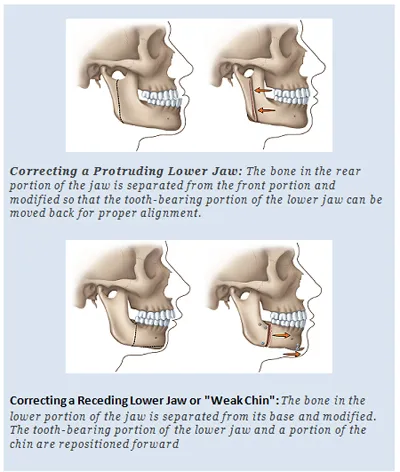 Jaw Surgery | Leesburg | Orthognathic Surgery | Misaligned Jaws
